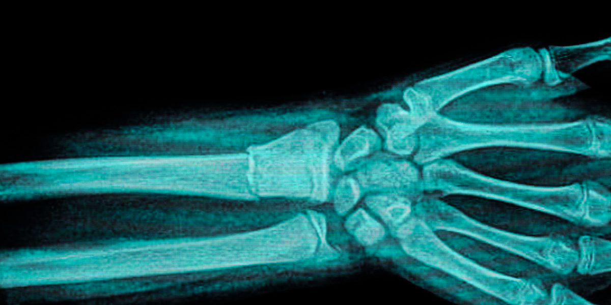 Distale Radiusfraktur: Ist Okklusionstraining sicher und effektiv? • pt ...