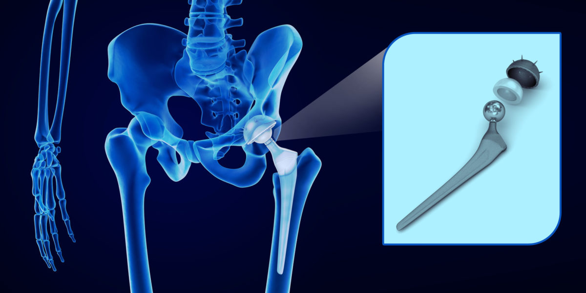 Hüft-TEP: Wie effektiv ist ein Training vor und nach dem operativen ...