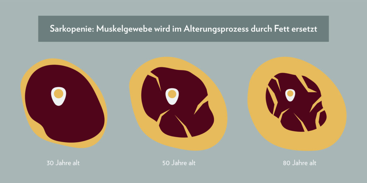Sarkopenie: Muskelerkrankung mit Folgen • pt Zeitschrift für ...